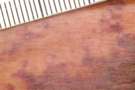 Calciphylaxis 2 Of 8 Niels Olson Flickr