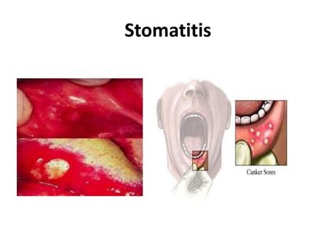 Stomatitis3 161023041115 1 Pptx