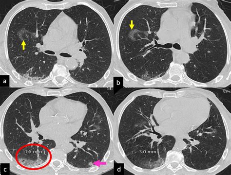 Ct Scan In Supine A C And Prone B D Position Some Rounded Areas Of Download Scientific