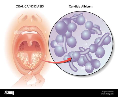 Oral Candidiasis Histology