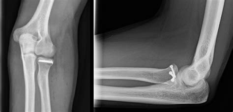 Compression Fracture Arm
