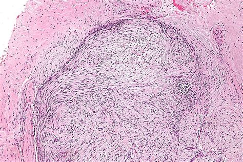 Nodular Fasciitis Libre Pathology