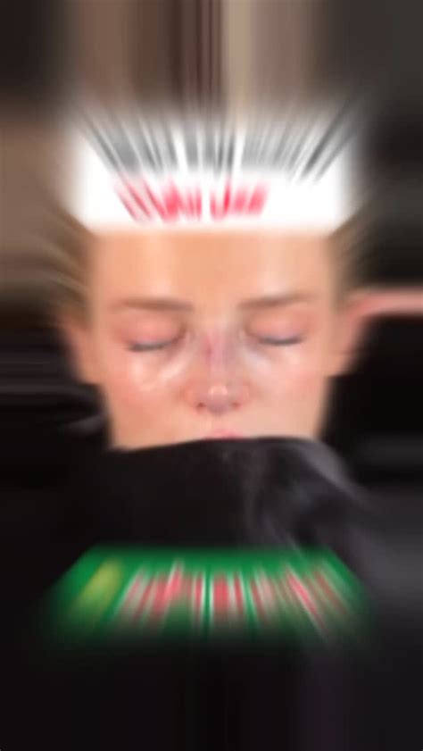 ‎کلینیک فرم دهی بینی آقای امیری بدون عمل داخل منزل‎ ‎ اگه میخوای عمل کنی کپشنو نخون بعد از