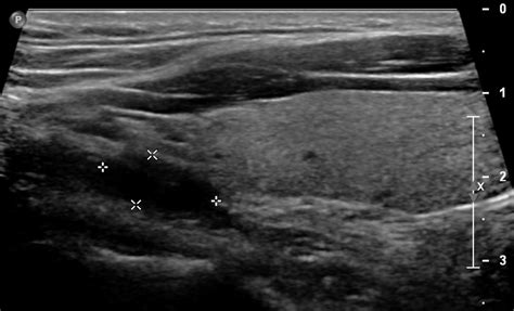 Parathyroid US Dr Iain Duncan