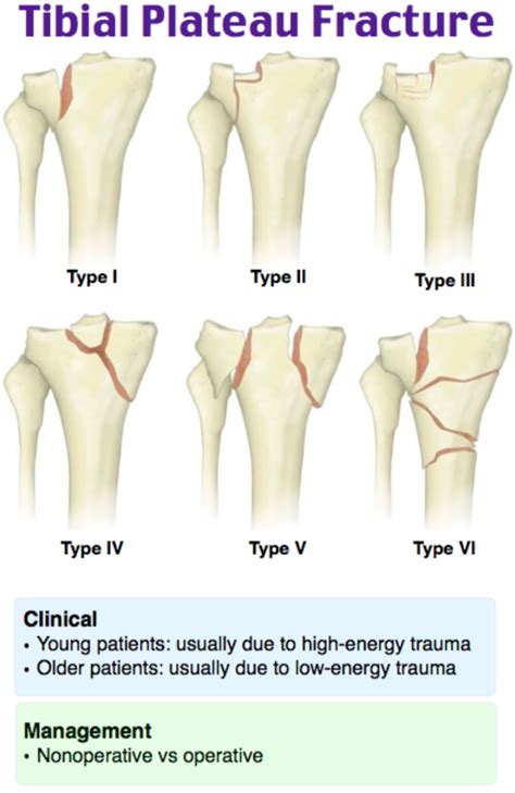 Cpt Code For Tibial Plateau Fracture Orif At Ada Michalski Blog