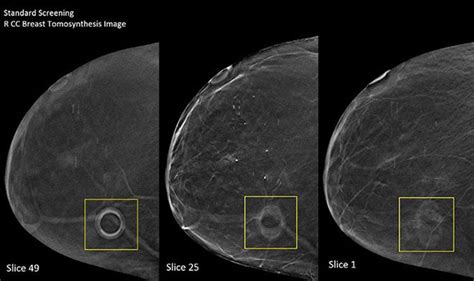 Reducing Slinky Artifact From Skin Markers In 3d Mammography