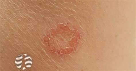 Discoid Eczema Day 13 Image Discoid Eczema Day 13 Image
