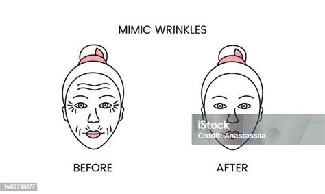 주름 시술 전과 벡터에 치료 라인 아이콘을 적용한 후 레이저 미용을 모방합니다 매끄럽고 깨끗한 피부와 문제성 피부를 가진 여성의
