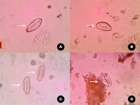 E Vermicularis Egg In The Typical Asymmetric Oval Shape Contains An