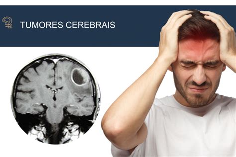 Tumor Cerebral1024×683 Dr Guilherme Rossoni