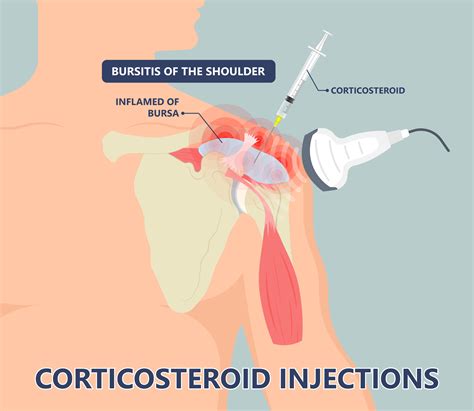 Steroids Injection