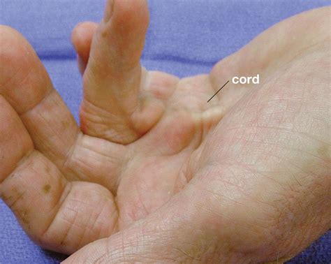 Hand And Wrist Tumors Carolina Hand And Sports Medicine