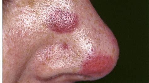 Hiv Spots On Lips