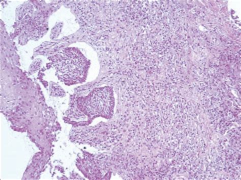 Islands Of Basaloid Cells With Peripheral Palisading And Clefting Are Seen Download Scientific