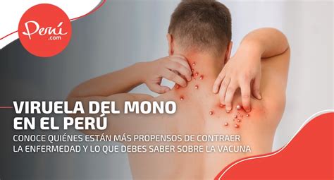 Viruela Del Mono En El Perú Todo Lo Que Se Sabe Sobre La Vacuna