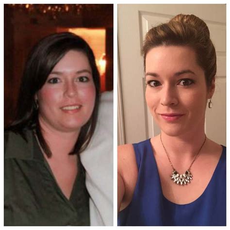Hypothyroid In Photos Before And After Stop The Thyroid Madness