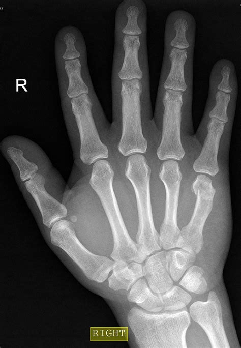 What Does Boxers Fracture Look Like At Clinton Spears Blog
