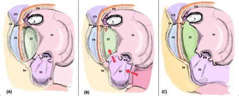 Diagram Of Retrotympanum Showing The Types Of Ponticulus Subiculum And