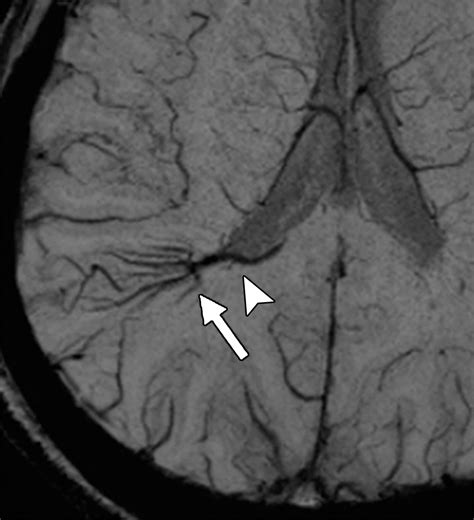 Thalamostriate Vein Radiology