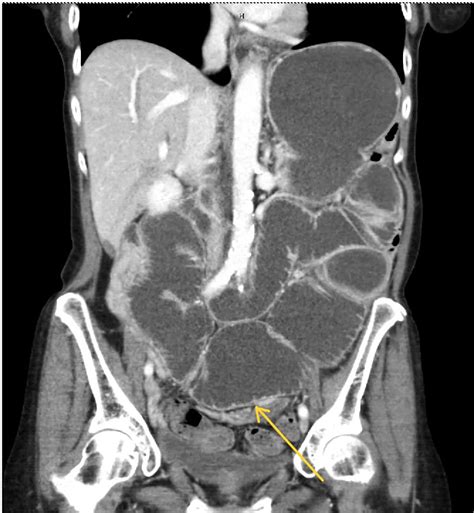 Figure 1 From Retrograde Eus Guided Ileocolostomy For Malignant Small