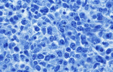 Testicular Diffuse Large B Cell Lymphoma Light Micrograph Stock