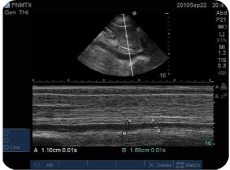 E Learning Acute Care Egls Echo Guided Life Support