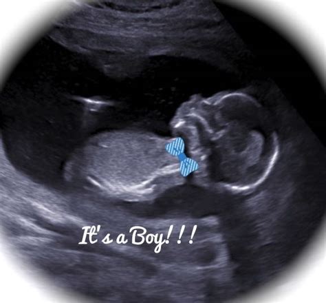What S The Difference Between D D D And D D D D Picture Me Baby Ultrasounds