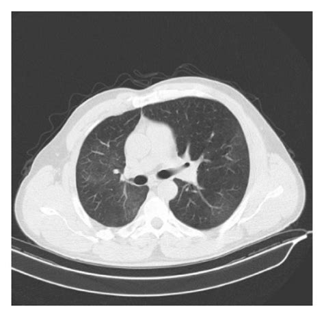 The Comparison Outcomes A Original Ct Image 4 Bd Segmentation