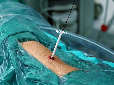 عمل Pcnl چیست؟ راهنمای کامل دکتر جعفری