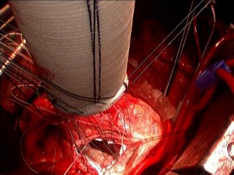 Ppt Pulmonary Valve Replacement With Bentallaortic Valve And Root