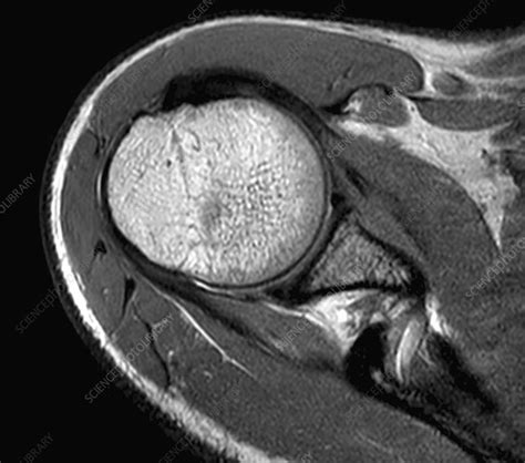 Healthy Shoulder Joint Mri Scan Stock Image C0489209 Science