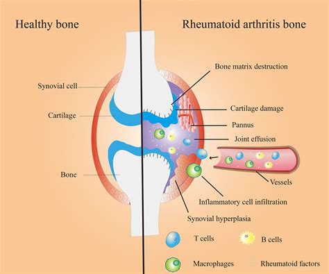 Rheumatoid Arthritis Joint