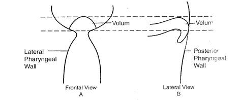 4 A Frontal View Of The Lateral Pharyngeal Walls The Lateral