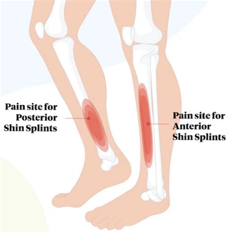 Shin Splints Symptoms And Treatment Guide QSMC