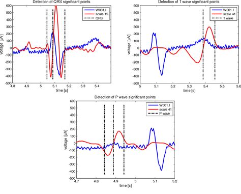 Figure 2 From A Wavelet Based Ecg Delineation With Improved P Wave Offset Detection Accuracy