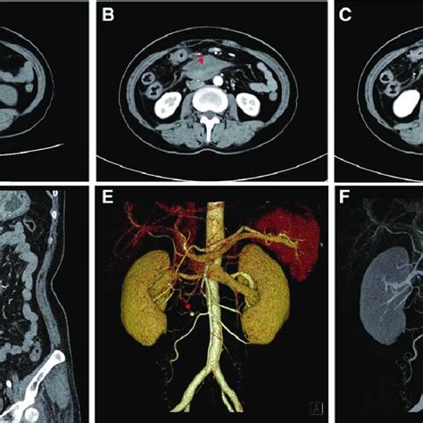 A Nonenhanced Ct Shows A Mass In Front Of The Duodenum Under The