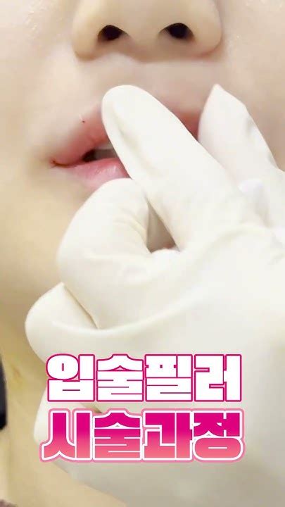 자연스러운 입술필러 시술 과정 전 후 입술필러 Shorts 입술 Filler Short 쇼츠 쇼트 Youtube