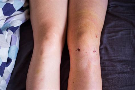 Arthroscopic Meniscus Repair