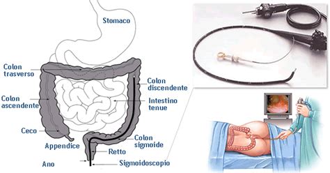 Sigmoidoscopía Proctosigmoidoscopía Procedimientos Quirúrgicos Sigmoidoscópicos
