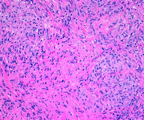 Pathology Outlines Sarcoidosis