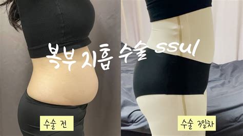 Sub 지방흡입 Vlog 복부 지흡 당일 썰 풀기 수술 순서 대공개 그리고 3일차 라인 공개feat골반 없는 사람 모여랏 Youtube