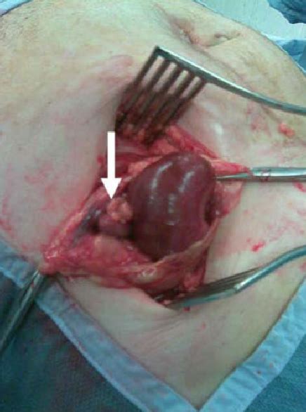 An Ischaemic Appendix White Arrow And Loop Of Terminal Ileum Within A