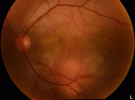 Serous Retinal Detachment