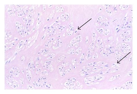 Vacuolization Of Myocytes In Phase 3 And 4 Fibroids Cytoplasmic
