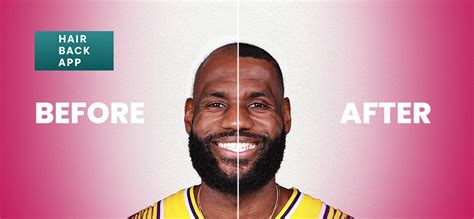 Lebron James Hair Transplant Simulation Awesome Result