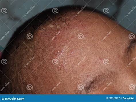 небольшие повреждения кожи на лбу Стоковое Изображение изображение насчитывающей цисты цист