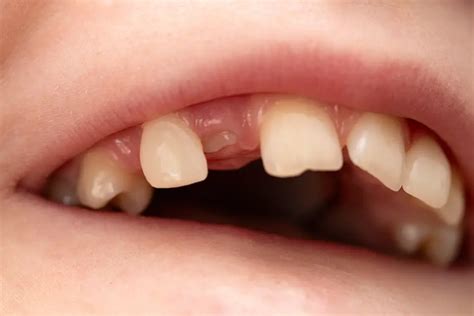 Tooth Broken Below The Gum Line