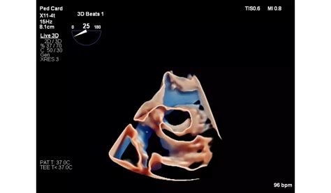 Epiq Cvx Cardiac Ultrasound