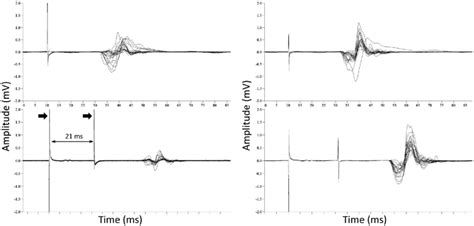 Overdrawing Of Meps Elicited By Single Pulse Stimulation Top And