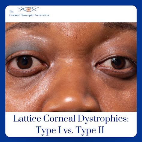 Eyeconditioneducation Cornealdystrophy Eyecondition Eyeproblems Eyecare Eyeprotection